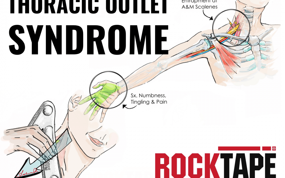 TREATING THORACIC OUTLET SYNDROME WITH IASTM – Rocktape UK